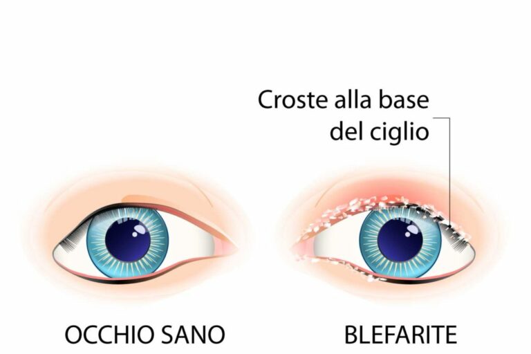 La blefarite, patologia infettiva della palpebra - Vision Future