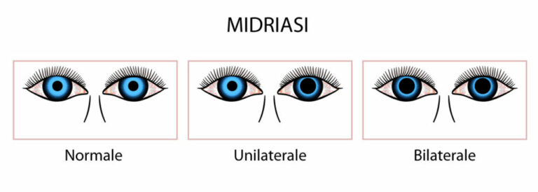 Pupille dilatate: cos'è la midriasi e da cosa è causata - Vision Future